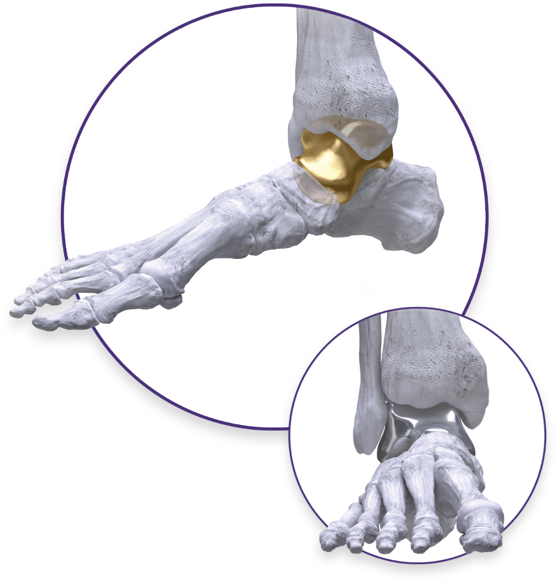 3D Patient Specific Talus Spacer – SMART28℠