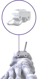 MAVEN™ Patient Specific Instrumentation (PSI) – SMART28℠